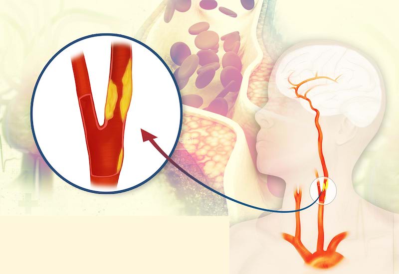Động mạch cảnh là gì? Các triệu chứng của bệnh động mạch cảnh