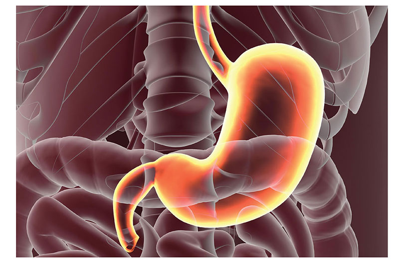 Hội chứng Zollinger Ellison là gì? Nguyên nhân và triệu chứng