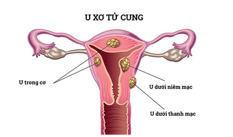 RONG KINH KÉO DÀI, ĐI KHÁM ĐƯỢC CHẨN ĐOÁN MẮC U XƠ TỬ CUNG